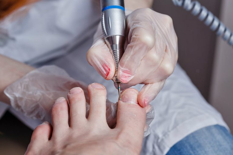 How Toenail Restoration Works with Fungal Nail Treatment | Dallas ...